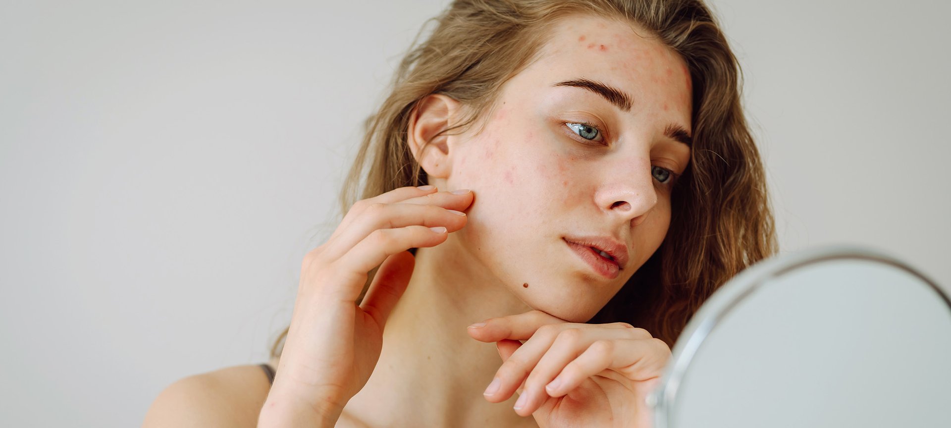 Whiteheads: Causes and How to Get Rid of Them - L'Oréal Paris