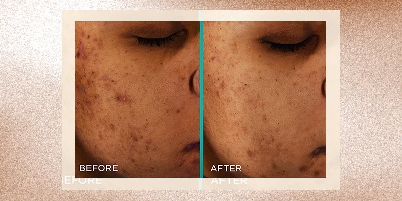 How to Get Clear Skin: 11 Tips to Try - L'Oréal Paris