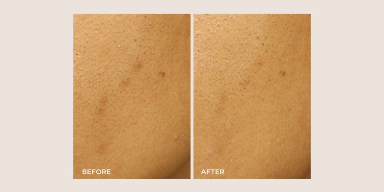 Everything To Know About PHAs in Skincare - L’Oréal Paris