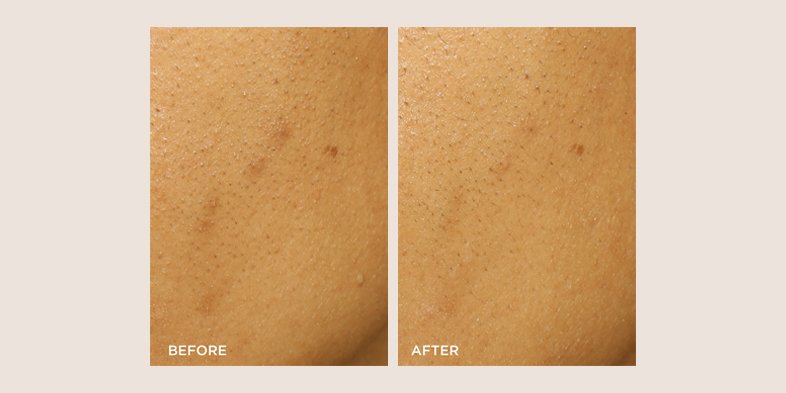 Skin Blemishes: 10 Types and How to Manage Them - L’Oréal Paris - L ...