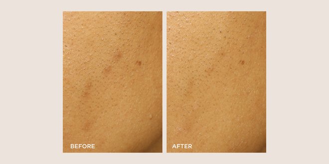 Skin Blemishes: 10 Types and How to Manage Them - L’Oréal Paris - L ...