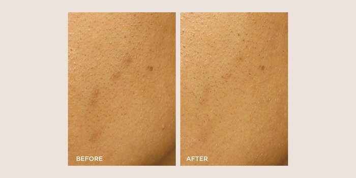 Skin Blemishes: 10 Types and How to Manage Them - L’Oréal Paris - L ...