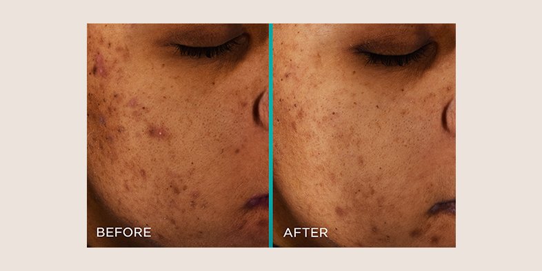 How To Address Dark Spots on Your Face - L’Oréal Paris