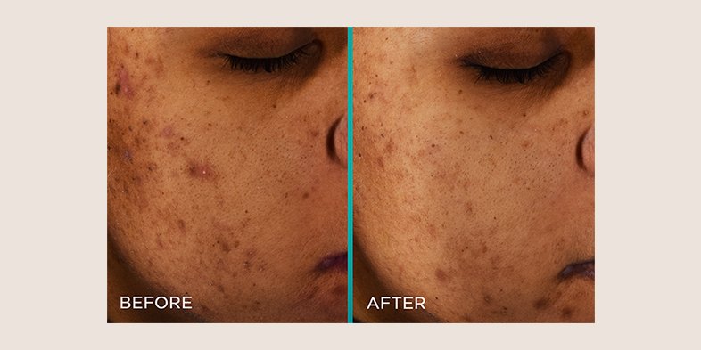 What Causes an Uneven Skin Tone?