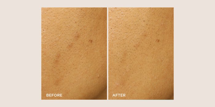 Why Do You Get Acne On or Between Your Eyebrows? - L’Oréal Paris