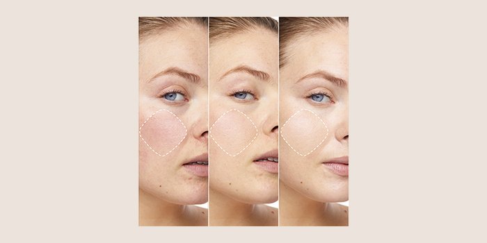 What Causes Ruddy Skin & How to Manage It - L’Oréal Paris