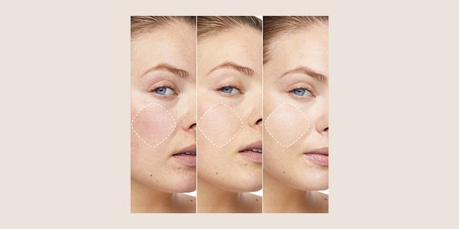 What Causes Ruddy Skin & How to Manage It - L’Oréal Paris