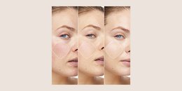 What Causes Ruddy Skin & How to Manage It - L’Oréal Paris