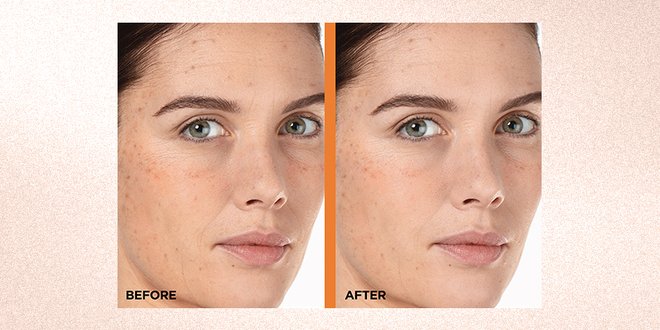 How to Improve and Prevent Orange Peel Skin - L’Oréal Paris