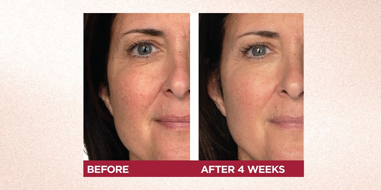 How to Improve and Prevent Orange Peel Skin - L’Oréal Paris