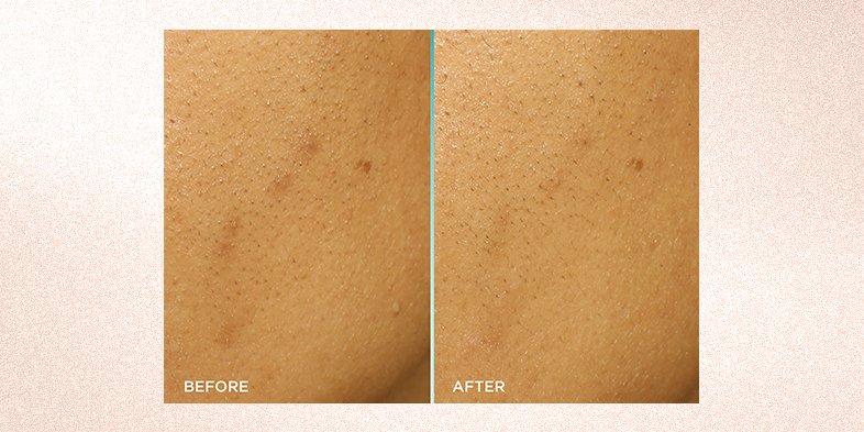 How to Improve and Prevent Orange Peel Skin - L’Oréal Paris