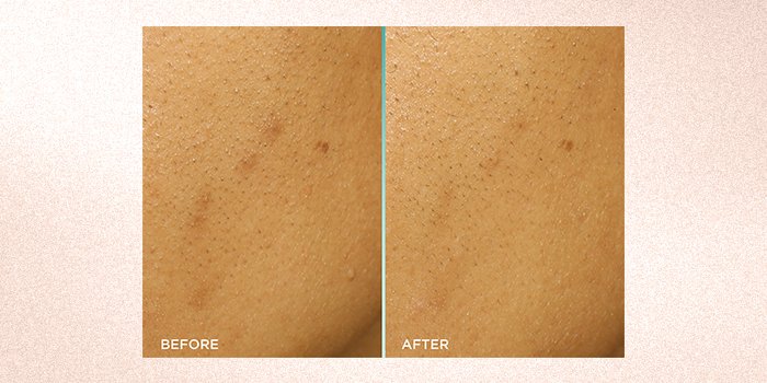 12 Tips To Help You Get Clear Skin | L’Oréal Paris