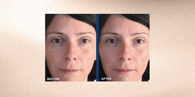 Is Niacinamide Good for Acne? | L'Oréal Paris