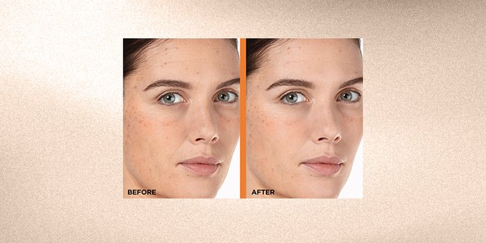 What Causes Ruddy Complexion and What Can You Do About It? | L’Oréal Paris