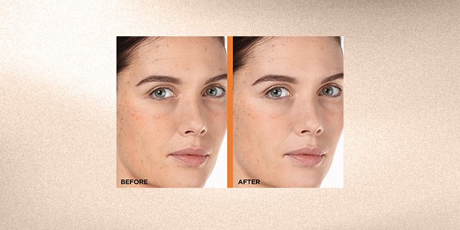 What Causes Ruddy Complexion and What Can You Do About It? | L’Oréal Paris