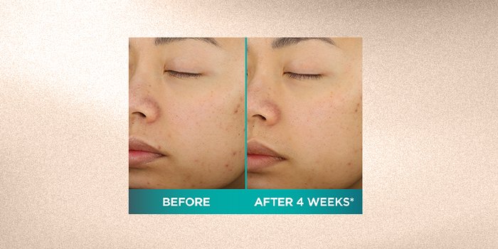 Skin Blemishes: 10 Types and How to Manage Them | L’Oréal Paris