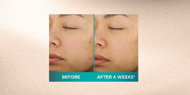 Skin Blemishes: 10 Types and How to Manage Them | L’Oréal Paris