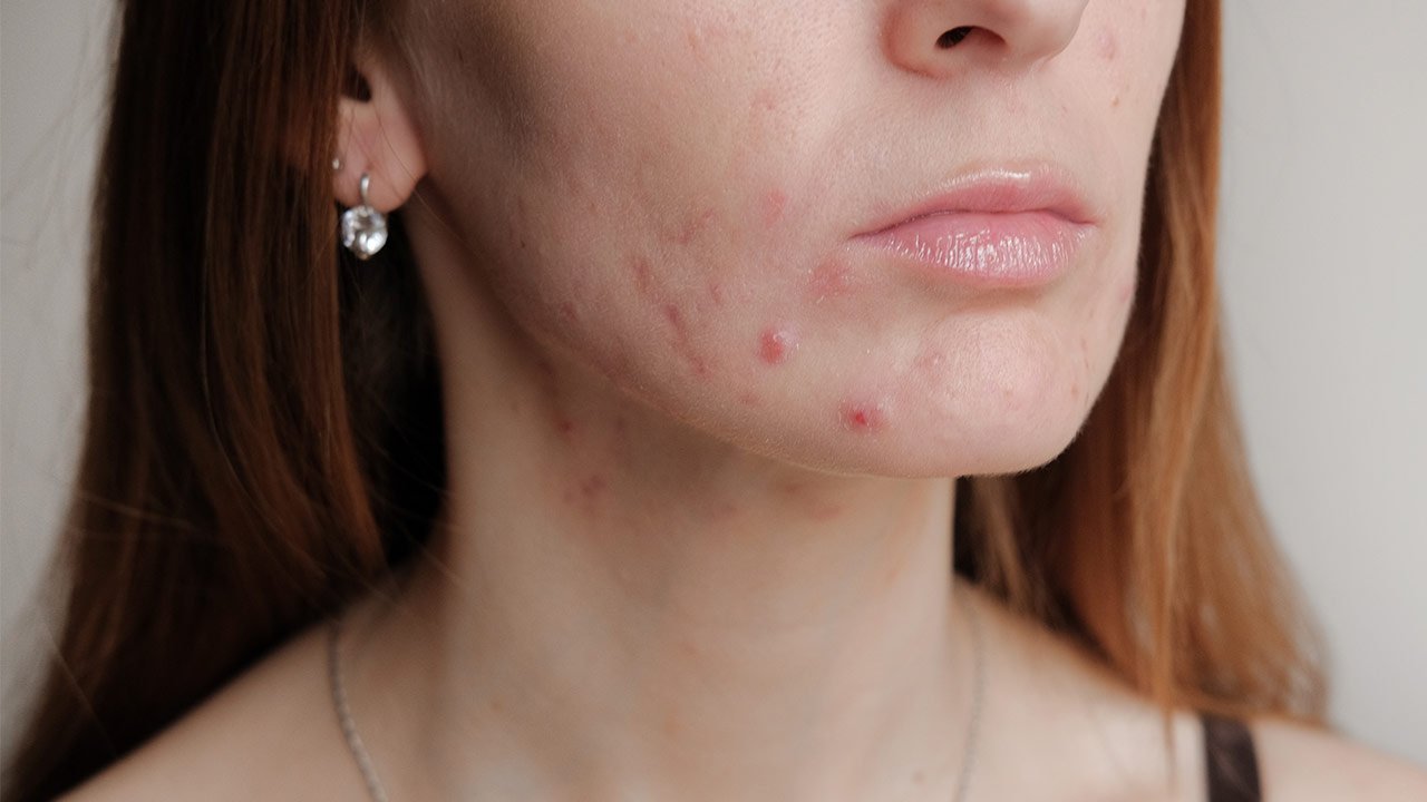 What Are Blemishes Identifying Spots On Your Face L Or al Paris