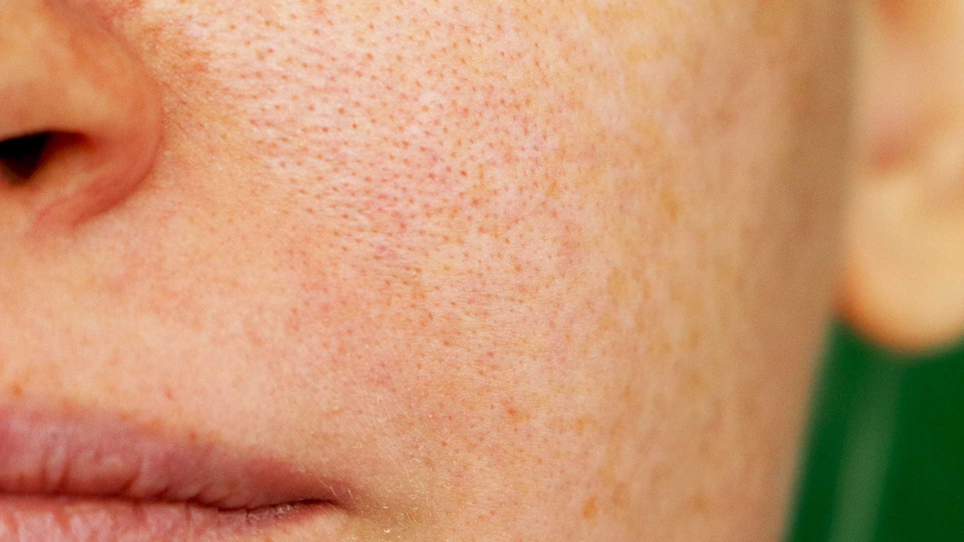 What Causes Orange Peel Skin At Ronaldbsellso Blog